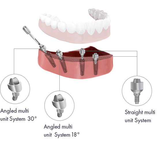 Angled Multi Unit Abutment